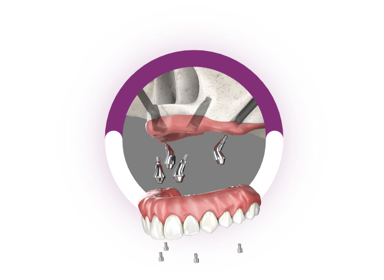 Neoarch Pack | Sistem implanturi PREMIUM | Green Dental