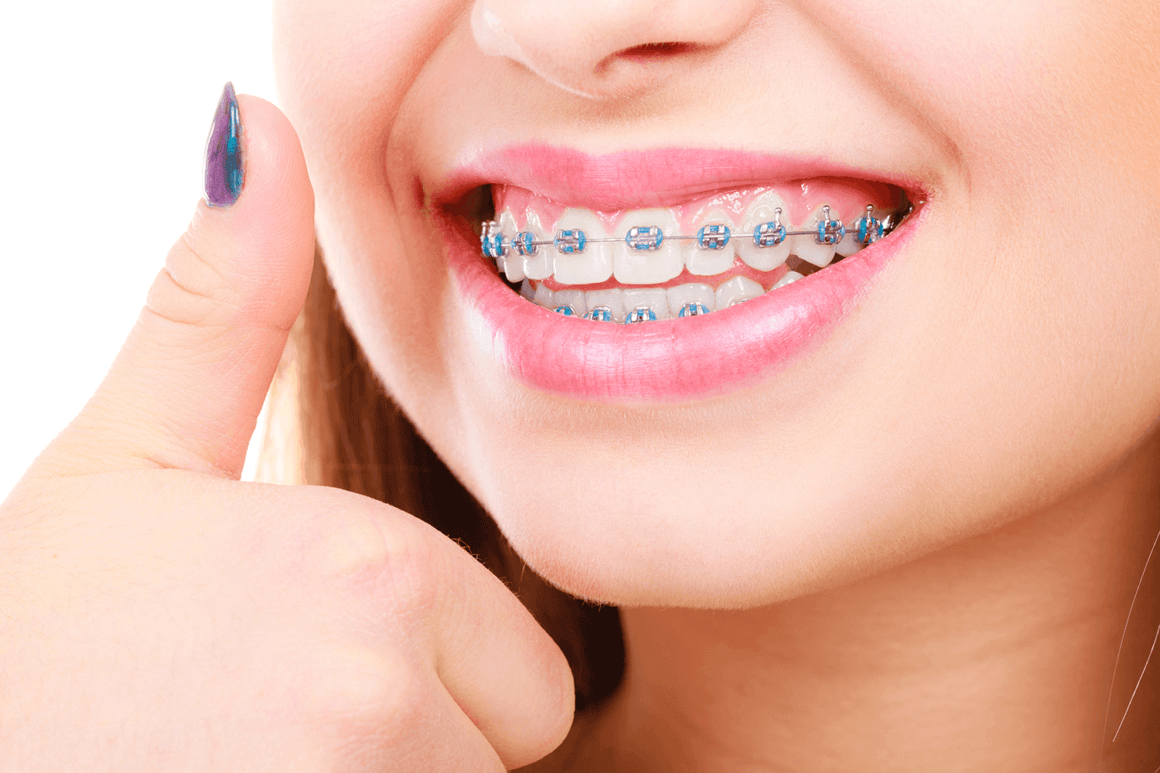 Aparat Dentar Pret Cat Costa Un Aparat Dentar In Functie De Tip aparat-dentar-pret-cat-costa-un-aparat-dentar-in-functie-de-tip